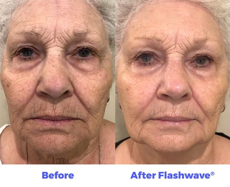 Shockwave Therapy for Cellulite, Wrinkles & Cellulite