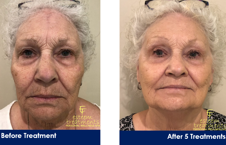 Acoustic Wave Therapy: An Effective Treatment for Cellulite, Wrinkles ...