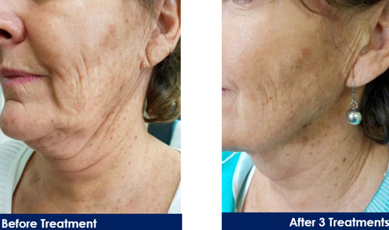 Acoustic Wave Therapy: An Effective Treatment for Cellulite, Wrinkles ...